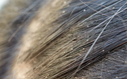 Reconnaitre le pou de tête - traitements anti-poux