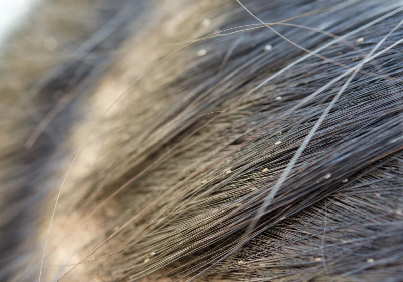 A quoi ressemble une lente - traitements anti-poux